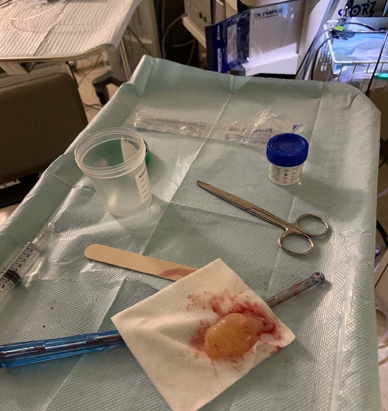 What You Should Know About Polyps/Nasal Obstruction - Glatz Group Sinus ...